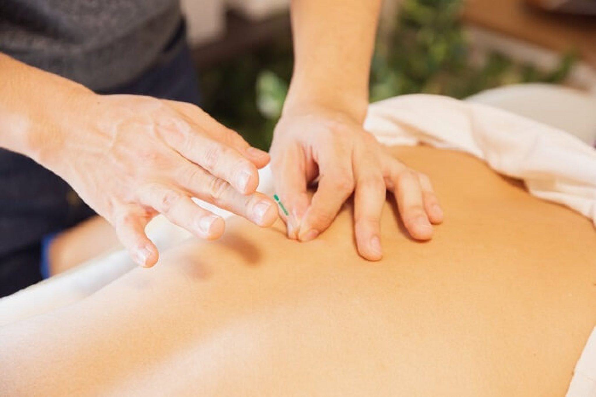 Acupuncture for Sciatica: Can it Cure your Back Pain?